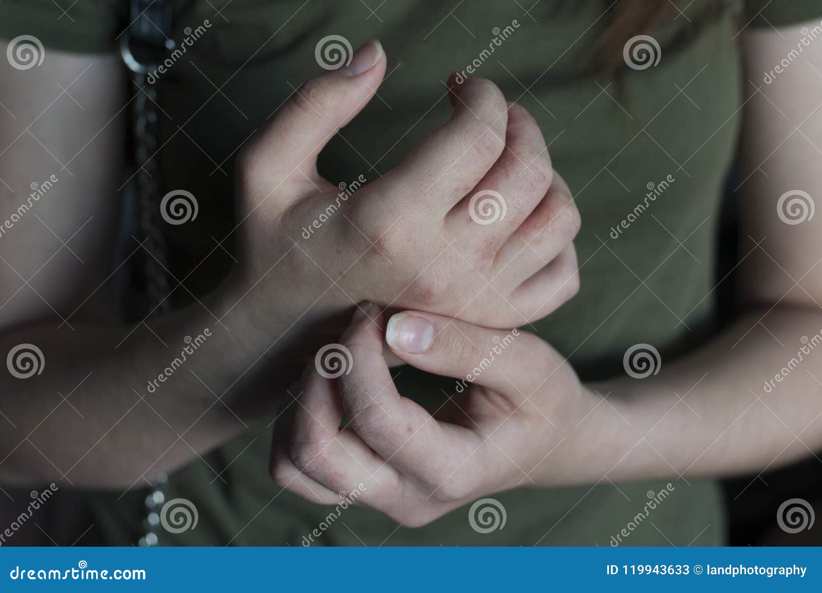 Dermatology Problem with Hands. Allergy Stock Image - Image of scabies ...