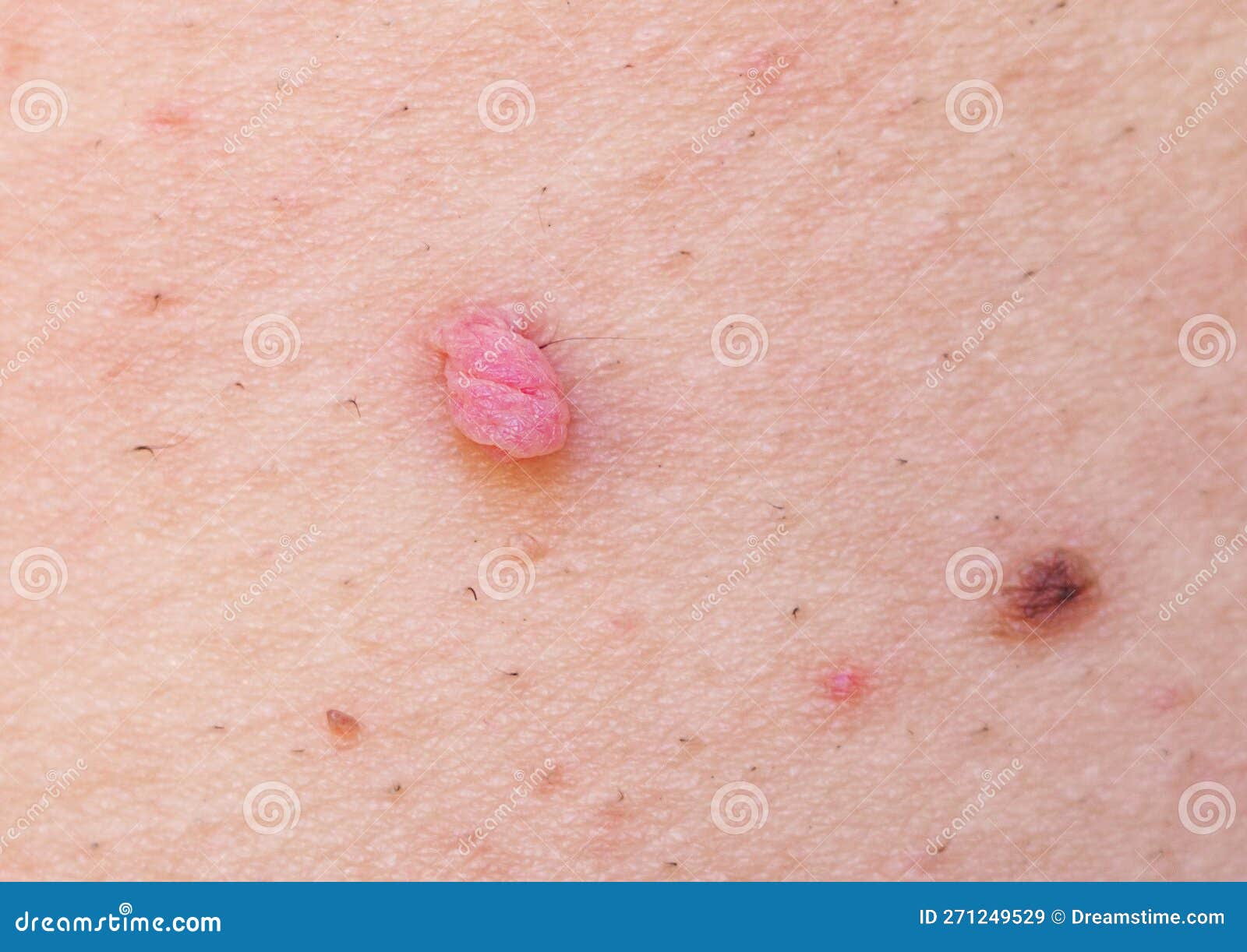Large Papilloma and a Mole on the Skin of the Armpit. Human Papilloma ...