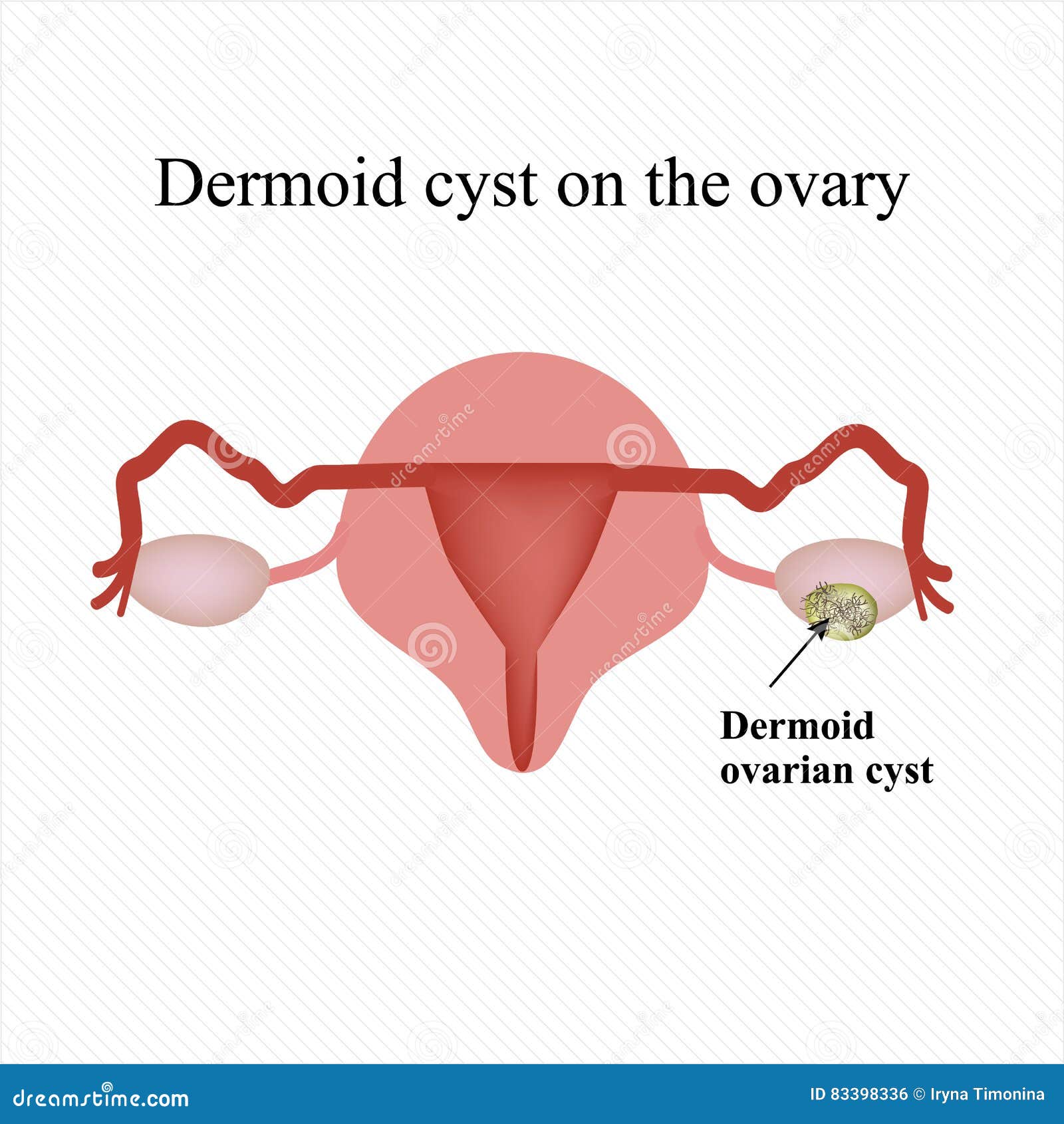 Dermoid Cyste Op De Eierstok Infographics Vector Illustratie Vector ...
