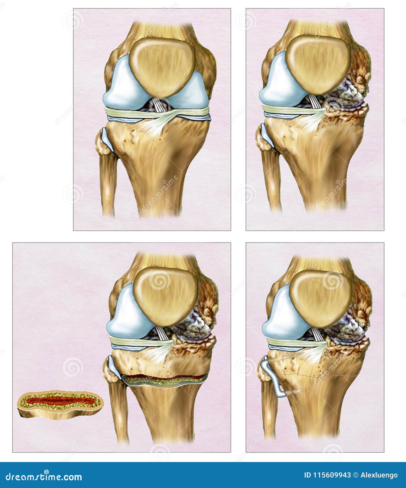 Descriptive Illustration An Osteotomy Or Correction Of The Knee Where ...