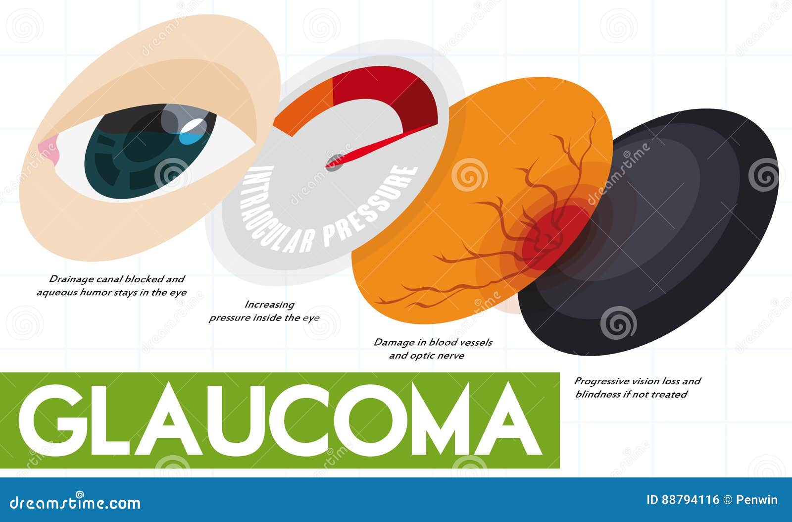 Descriptive Infographic Showing Some Stages of Glaucoma Disease, Vector ...