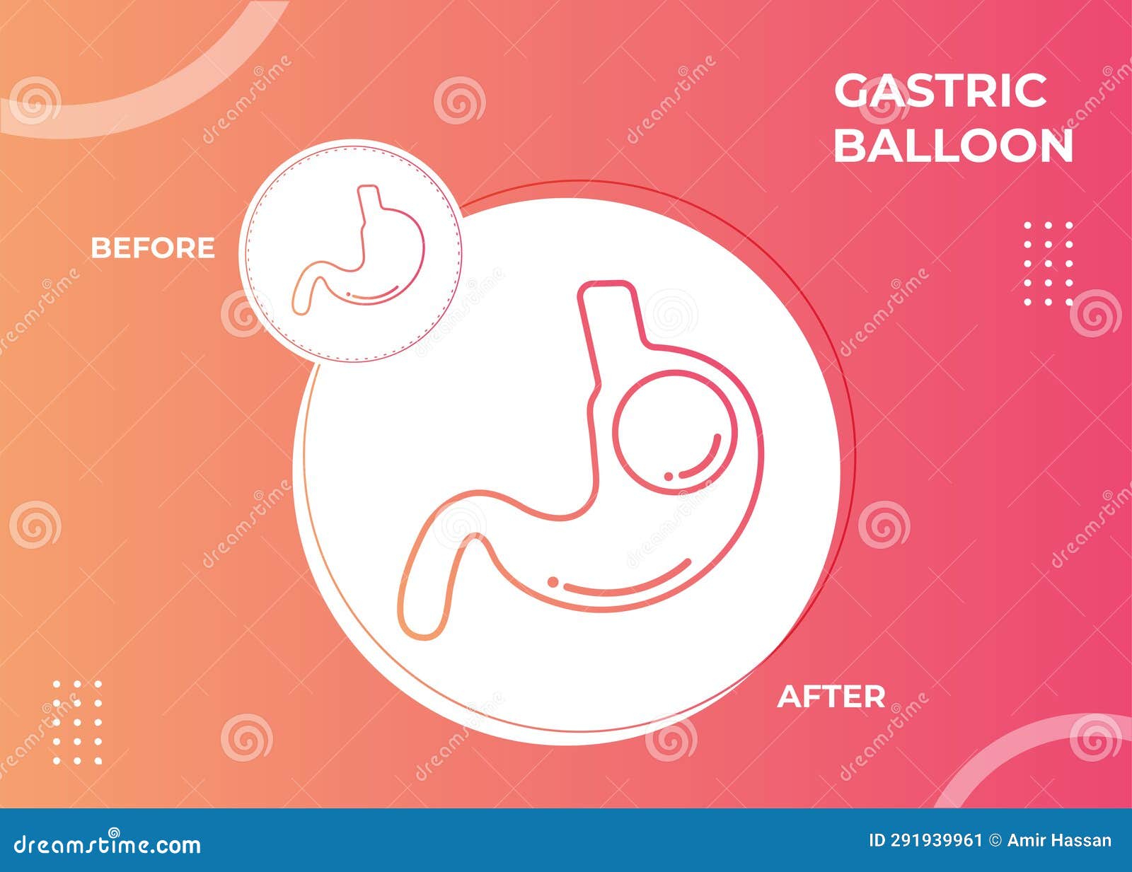 Stomach Endoscopy Gastric Balloon Inside a Stomach Weight Loss Surgery ...