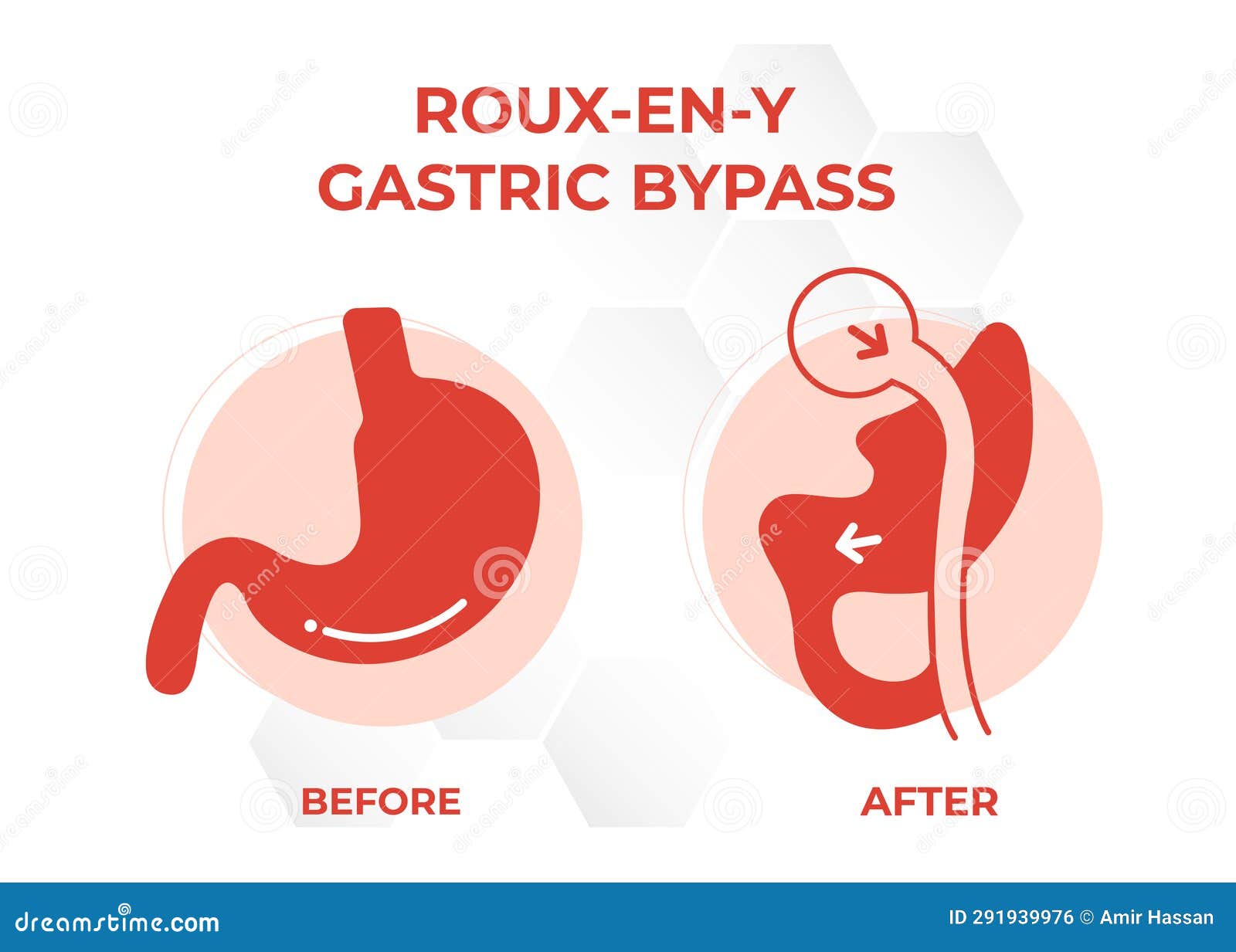 Roux-en-Y Gastric Bypass (RNY) Weight Loss Surgery Vector Illustration ...