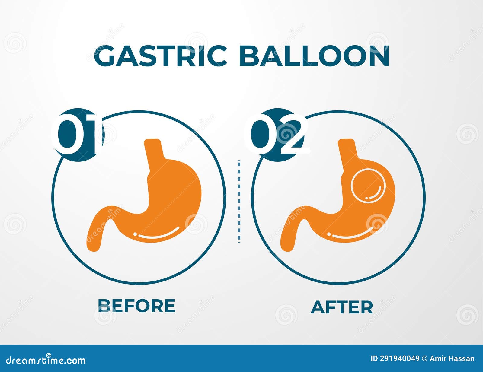 Stomach Endoscopy Gastric Balloon Inside a Stomach Weight Loss Surgery ...