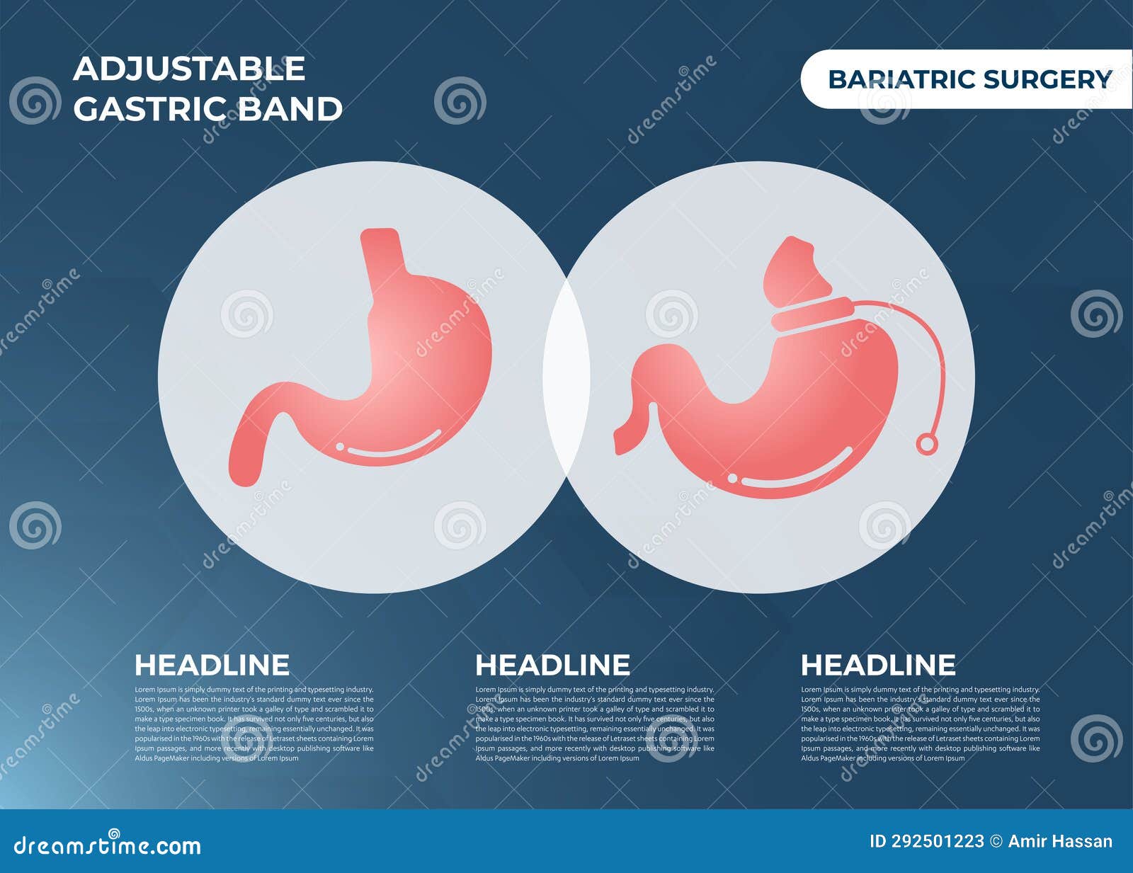 Illustration of Adjustable Gastric Band Devise Weight Loss Surgery ...