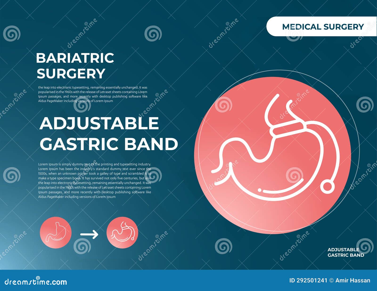 Illustration of Adjustable Gastric Band Devise Weight Loss Surgery ...
