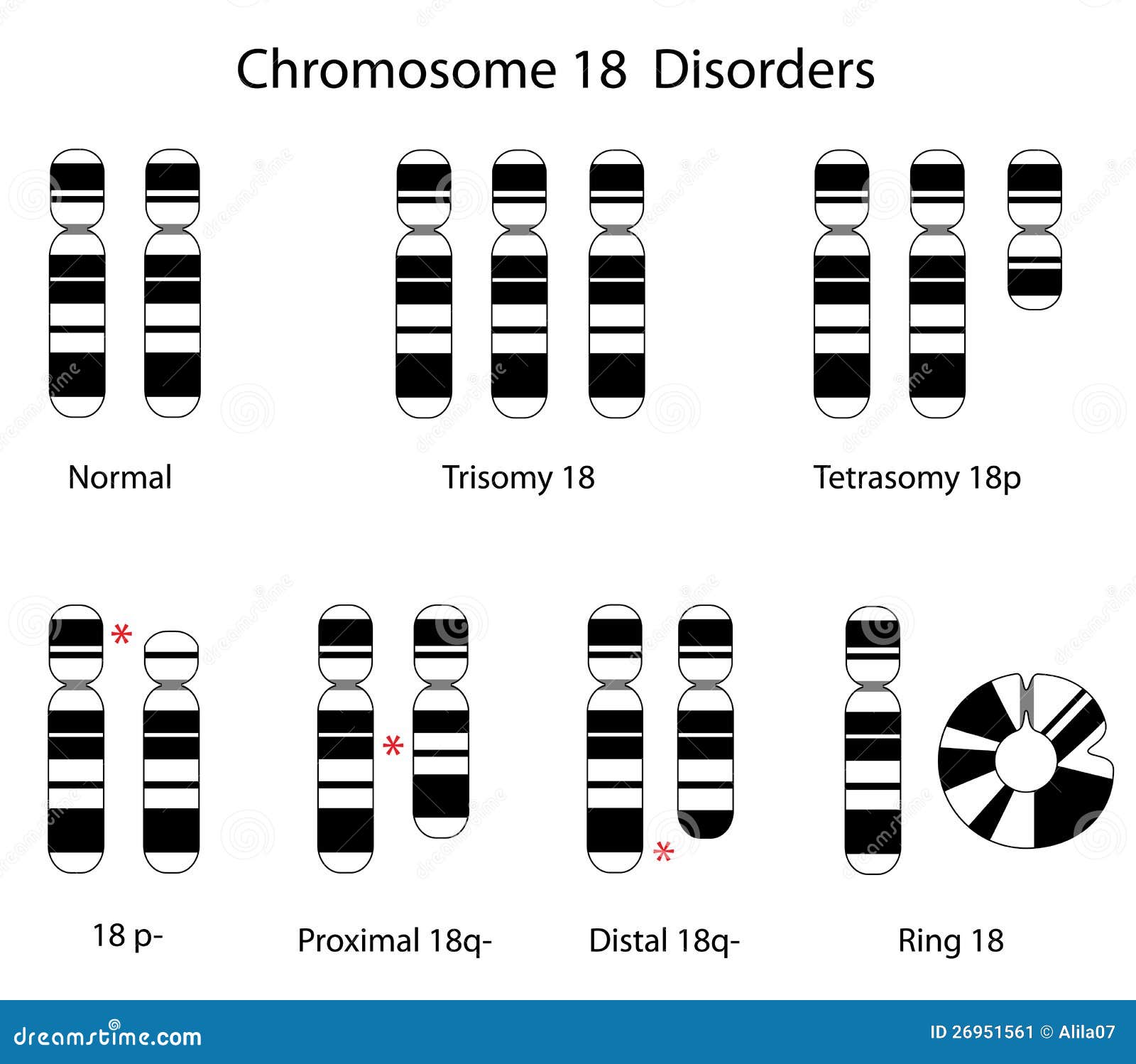 Desordenes Del Cromosoma 18 Ilustración del Vector - Imagen: 26951561