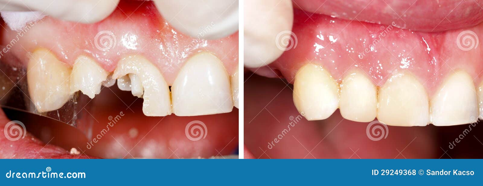 Destructed teeth filling stock photo. Image of caries - 29249368