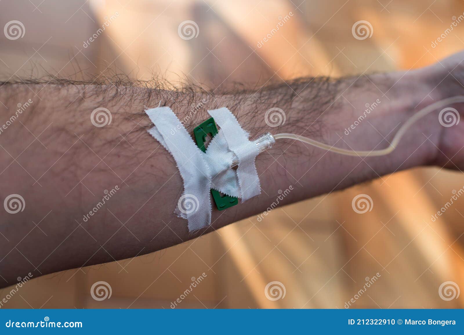 Detail of Arm with Drip Attached Stock Photo - Image of infection ...