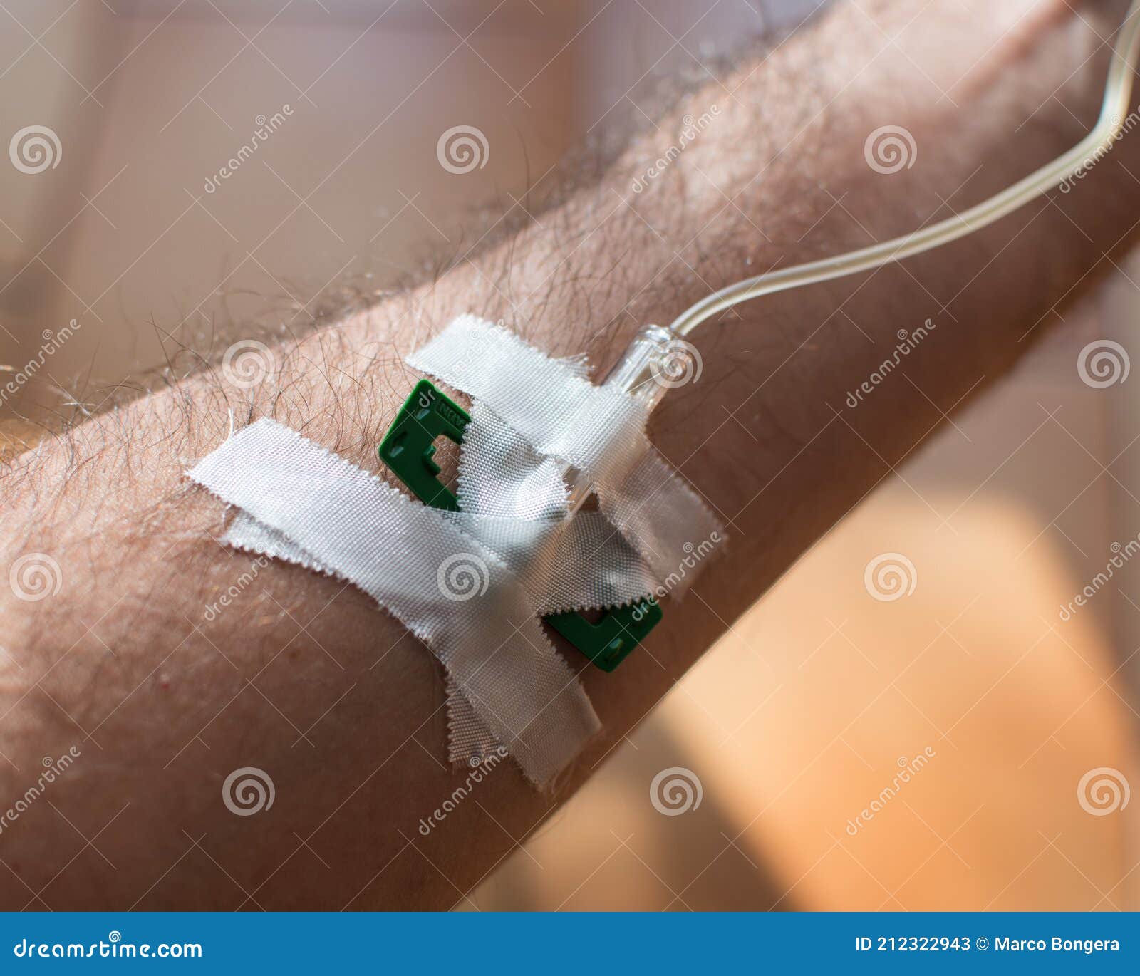 Detail of Arm with Drip Attached Stock Image - Image of influenza ...