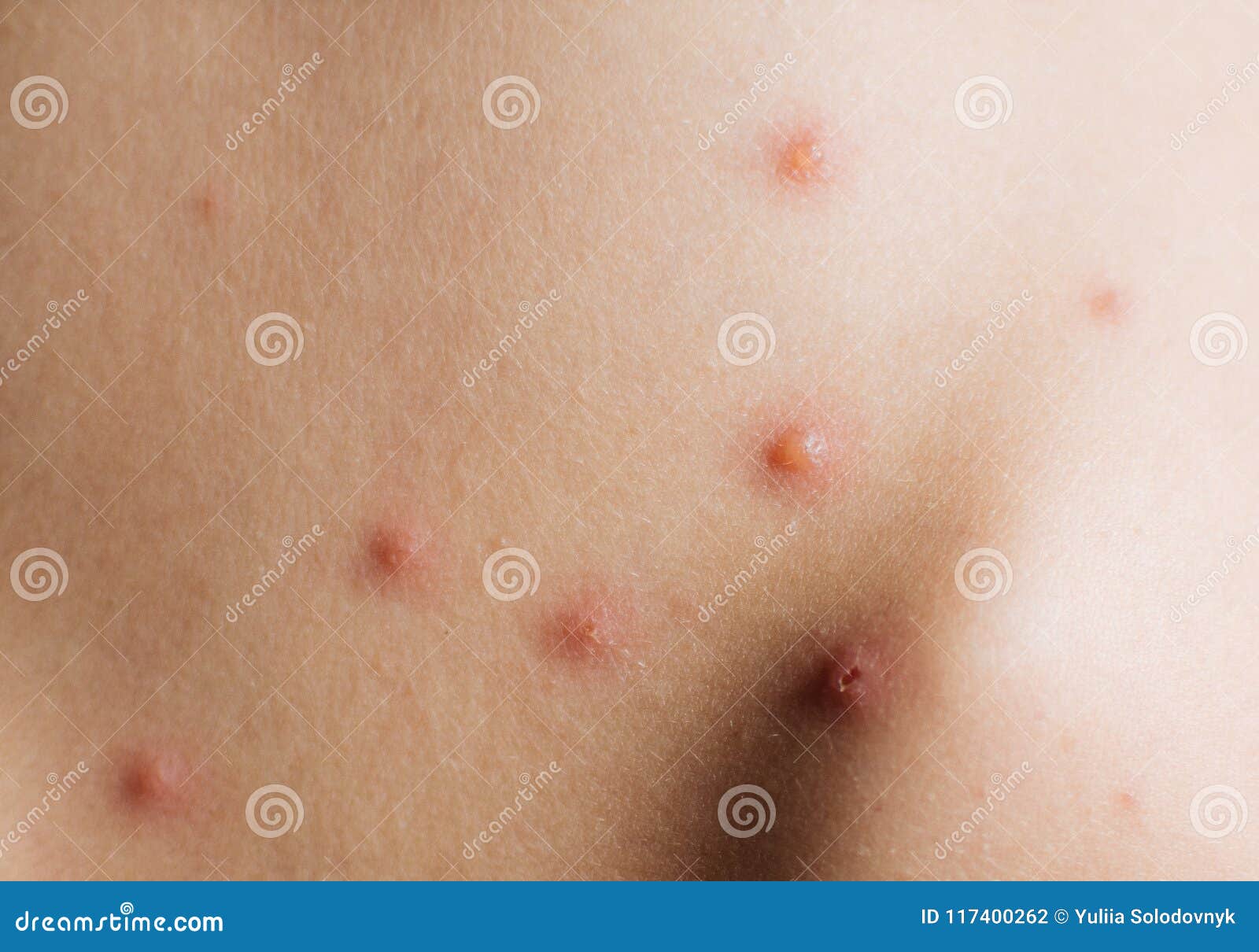 Detail Baby with Chicken Pox Rash Stock Photo - Image of blister ...