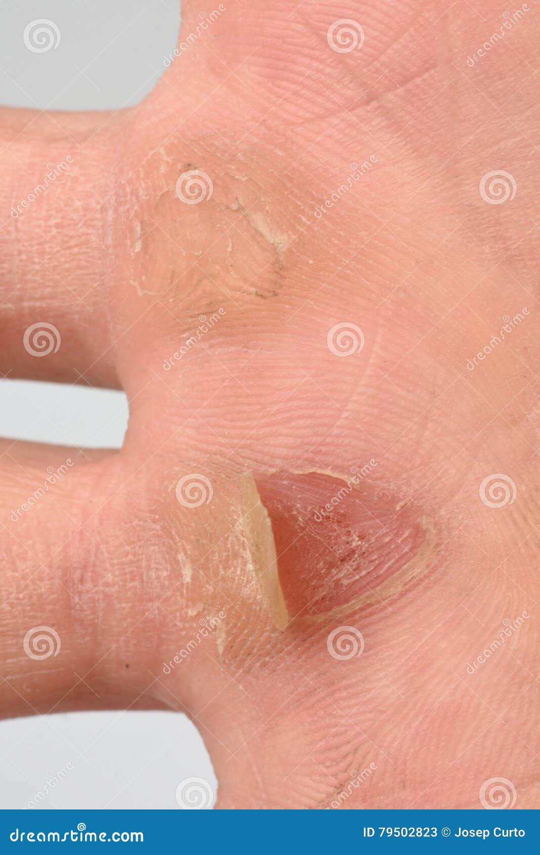 Detail of calluses stock image. Image of closeup, palm - 79502823
