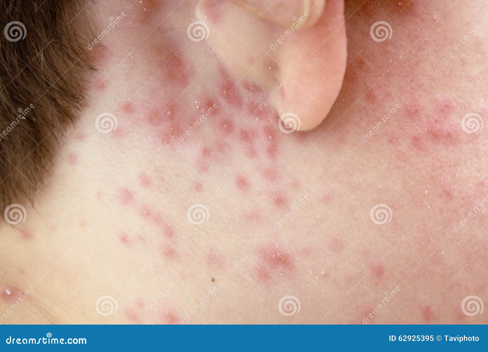 Detail of Chicken Pox Effects Stock Image - Image of rash, healthcare ...