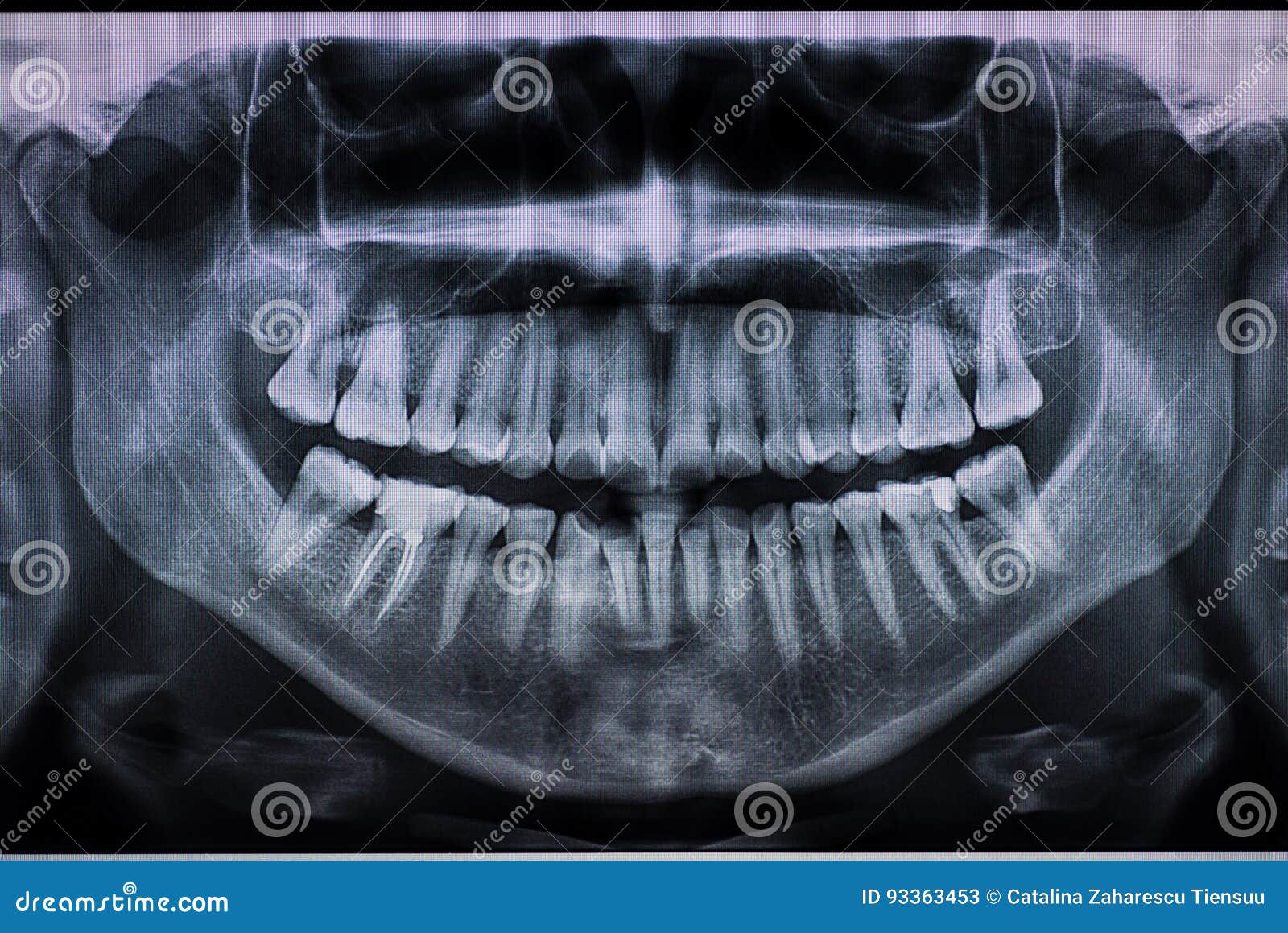 Detail of Dental X Ray with a Root Canal Stock Image - Image of ...