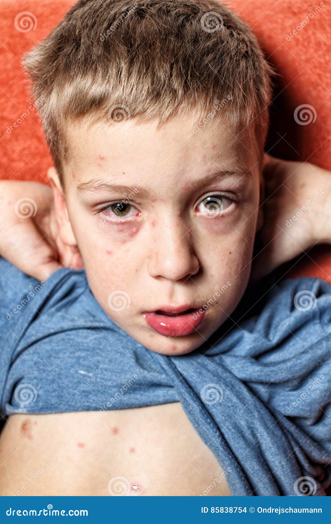 Detail of the Face of Boy with Small-pox Stock Photo - Image of illness ...