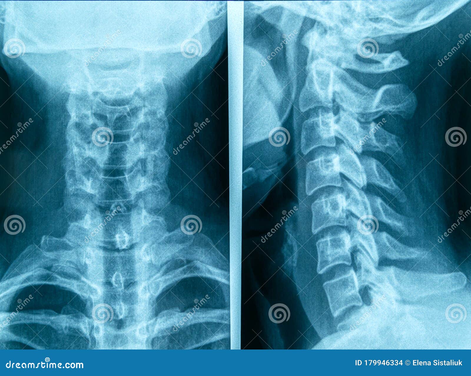 Detail of Human Neck X-ray Image Stock Photo - Image of healthcare ...