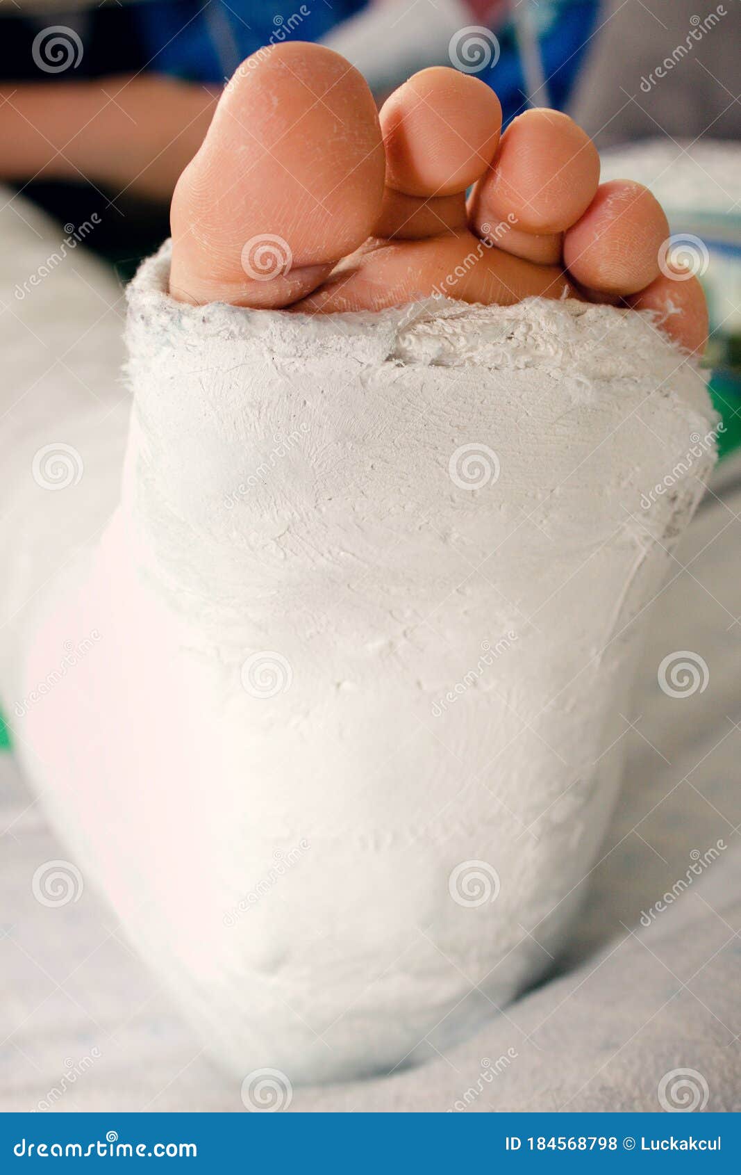 Detail of the Left Leg or Foot in White Plaster. Stock Photo - Image of ...