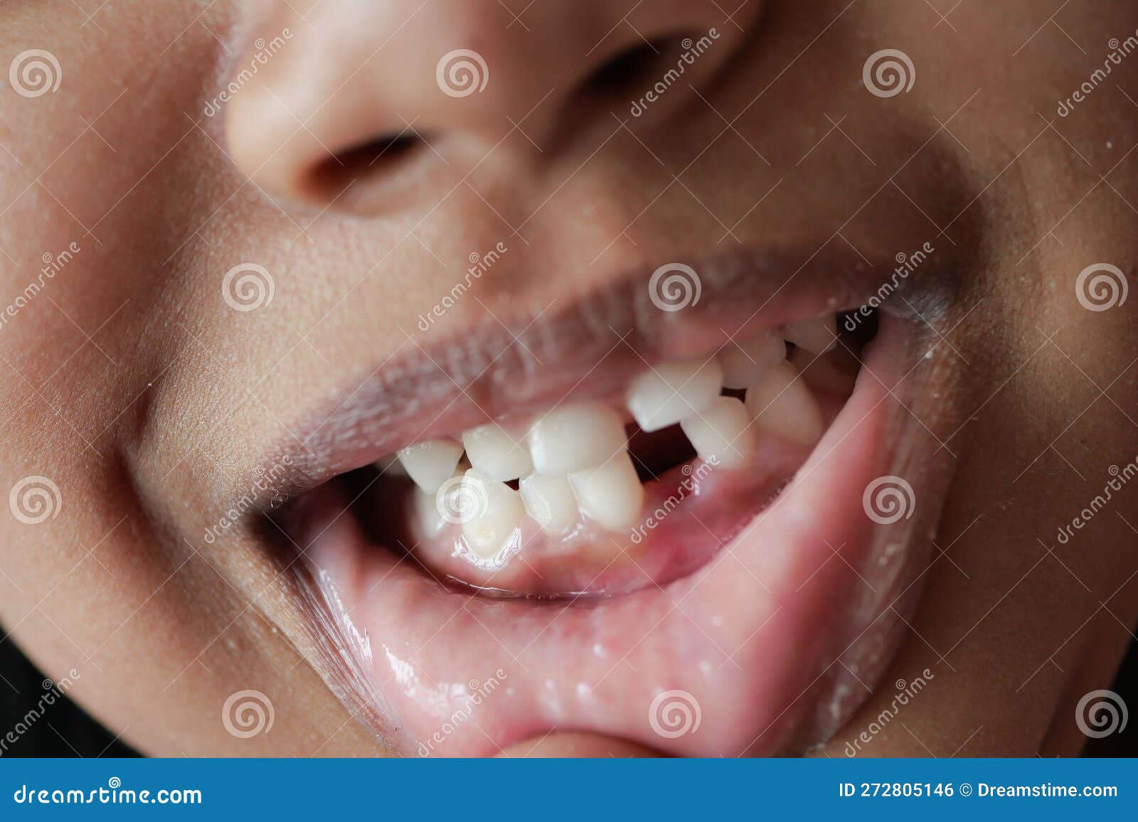 Detail Shot of Child with Teeth Missing Stock Photo - Image of dental ...