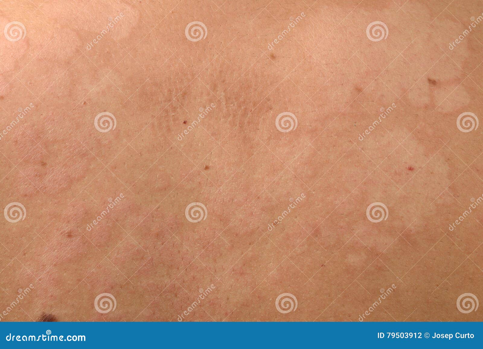 Detail of skin stock photo. Image of diseased, care, person - 79503912