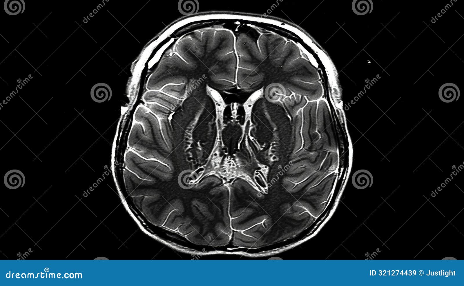 Detailed CT Scan of a Brain Displaying Advanced Atrophy Stock Image ... Detailed CT Scan of a Brain Displaying Advanced Atrophy Stock Image ...