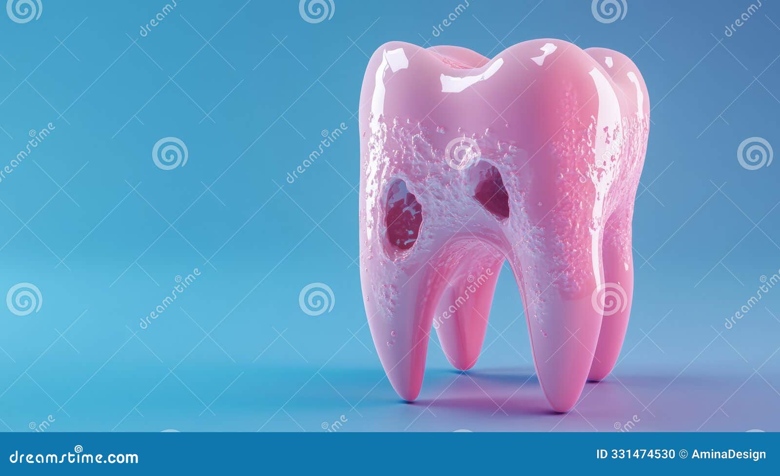 A Detailed 3D Model of a Decayed Tooth Showing Plaque and Cavities for ...