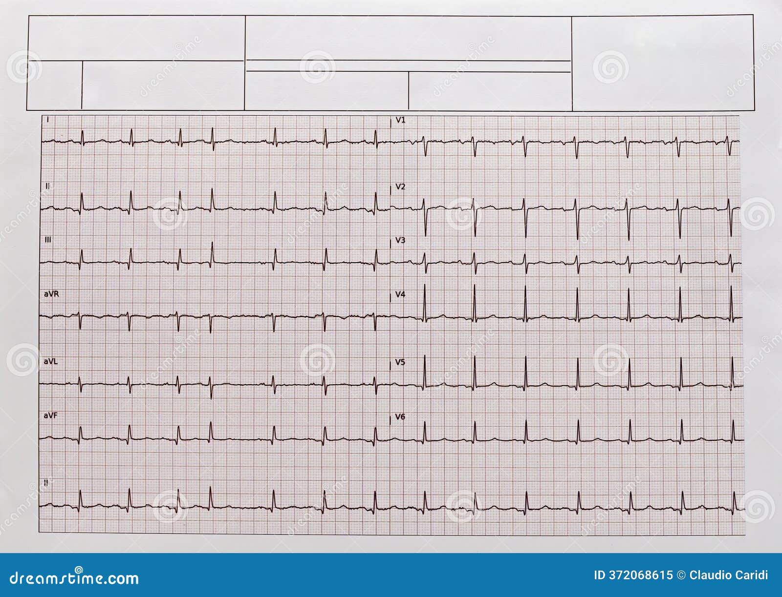 Detailed EKG, ECG, Electrocardiogram Showing Heartbeat Patterns ...