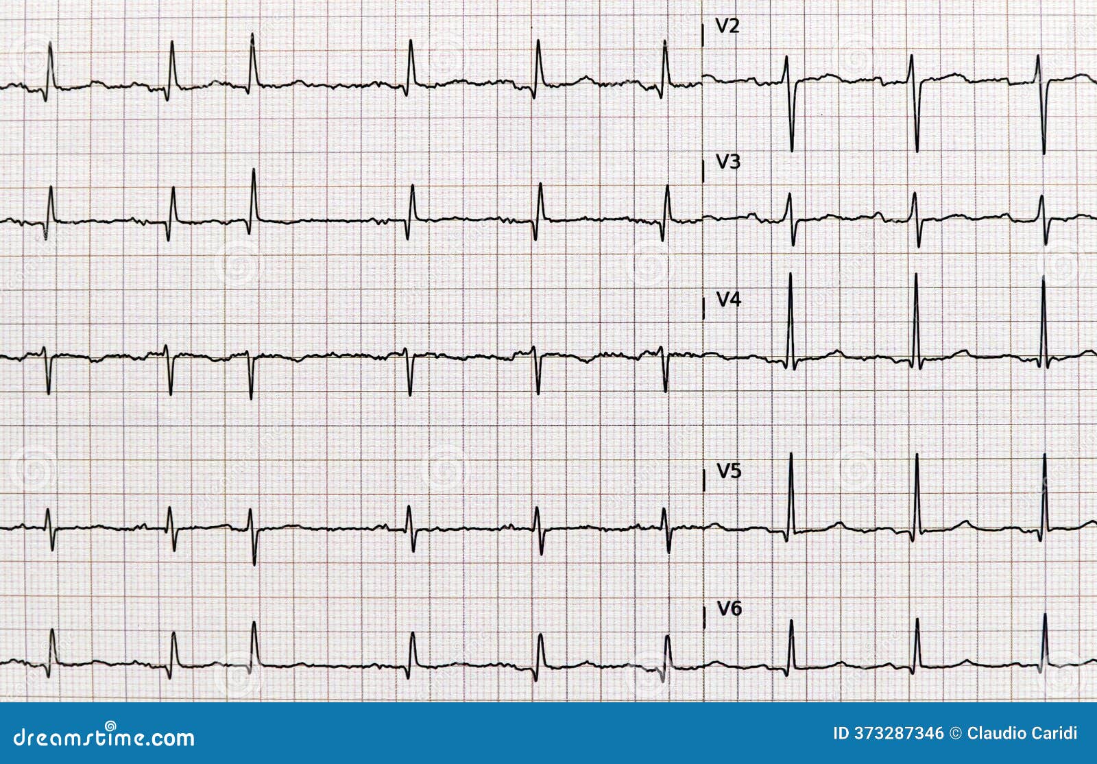 Electrocardiogram Showing A Supraventricular Tachycardia And Colored ...