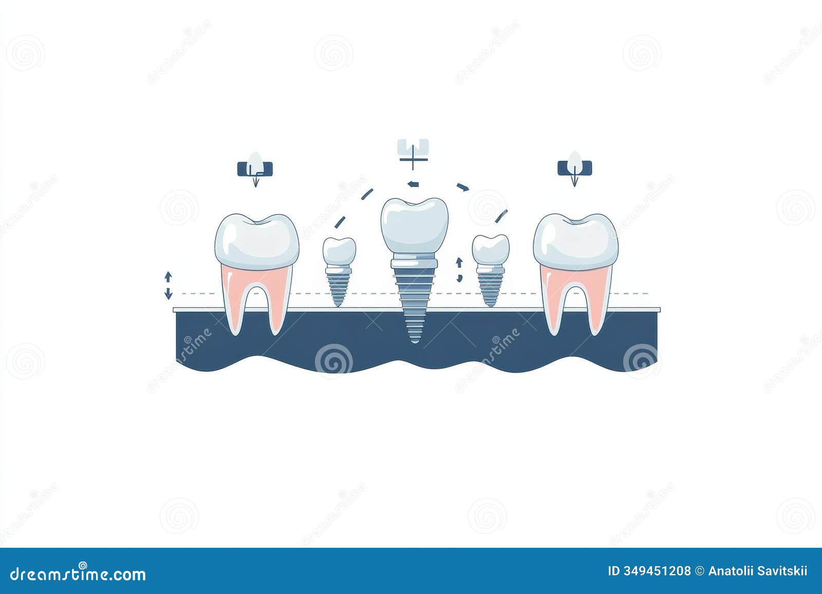 Detailed Illustration Showcasing the Three Stages of the Dental Implant ...
