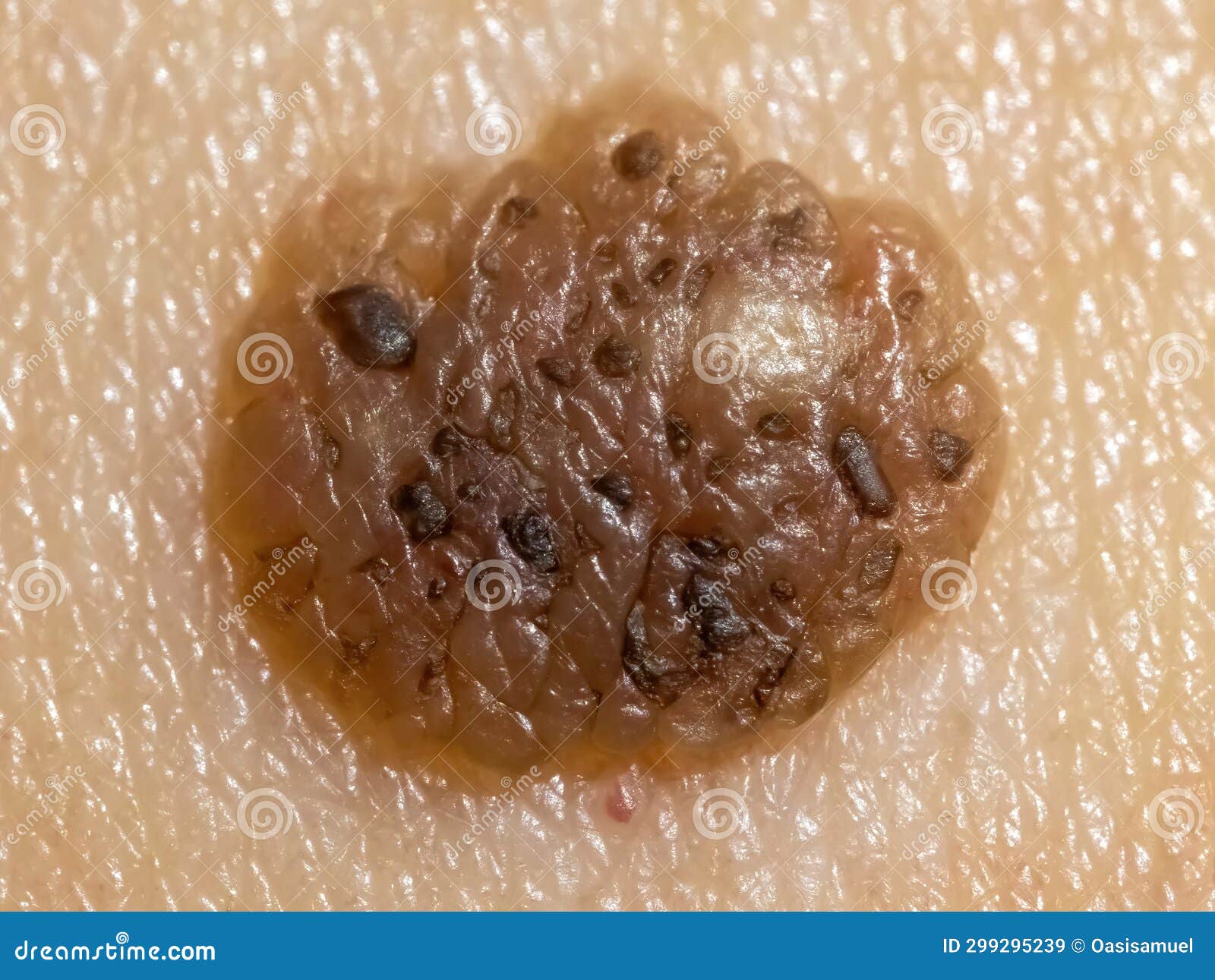 A Detailed Macro View of a Mole with Potential Indications of Malignant ...