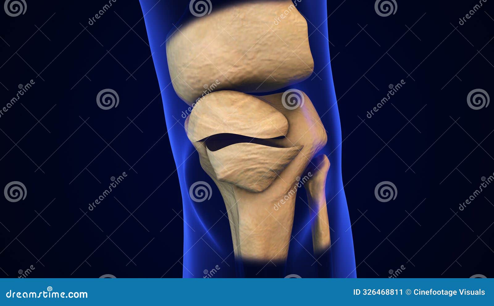 Broken Patella Bone Medical Concept Stock Illustration - Illustration ...
