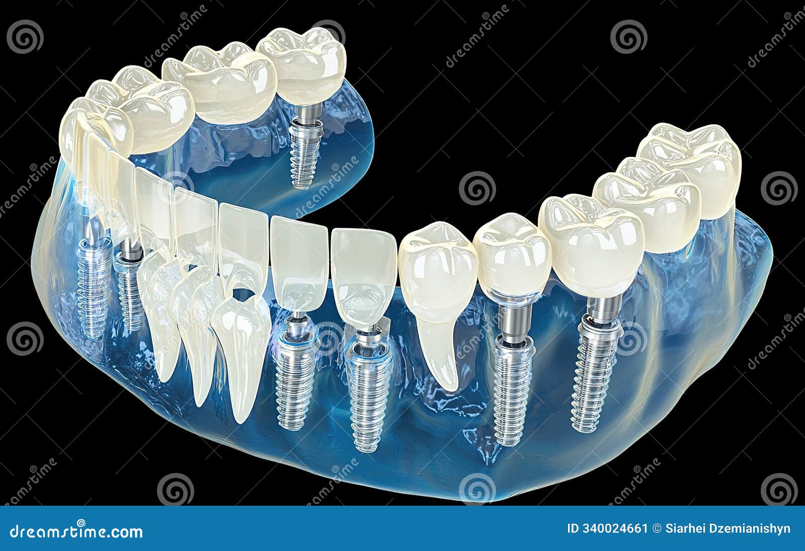 Detailed Overview of Dental Implants Arranged in a Dental Model Showing ...