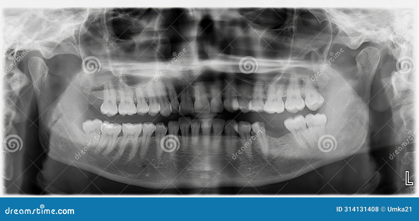Detailed Panoramic Dental X-ray Showing Teeth Structure. Stock Photo ...