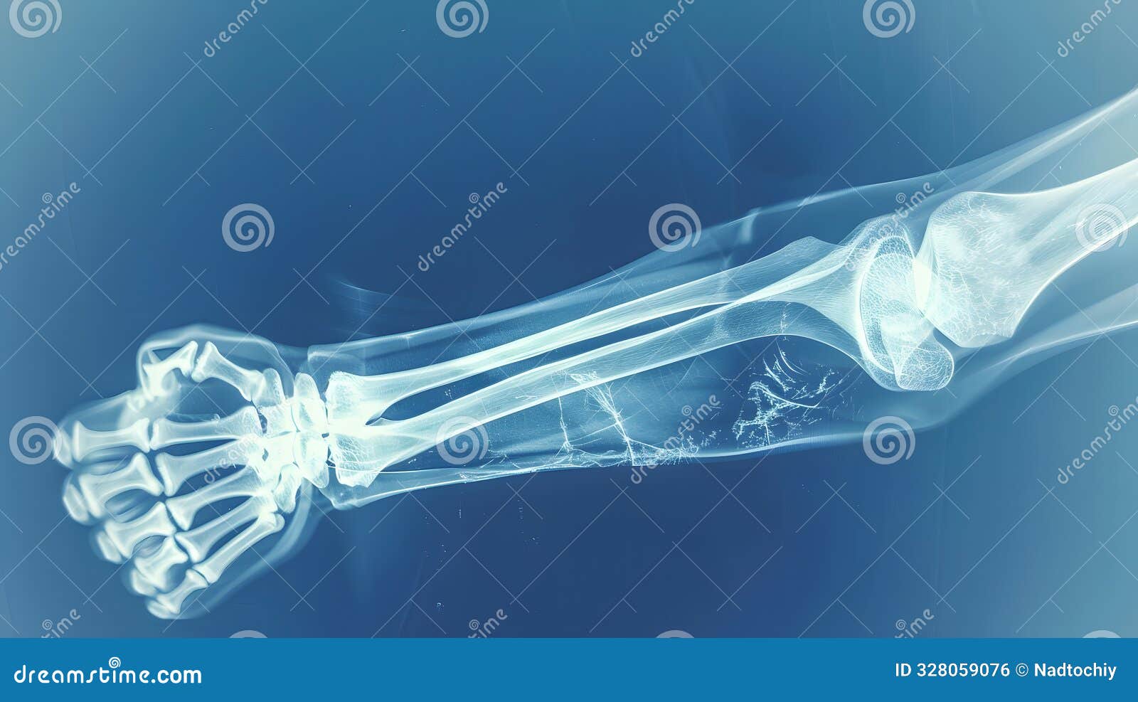 X-ray Image of a Human Forearm Showing Bones and Joints Health Stock ...