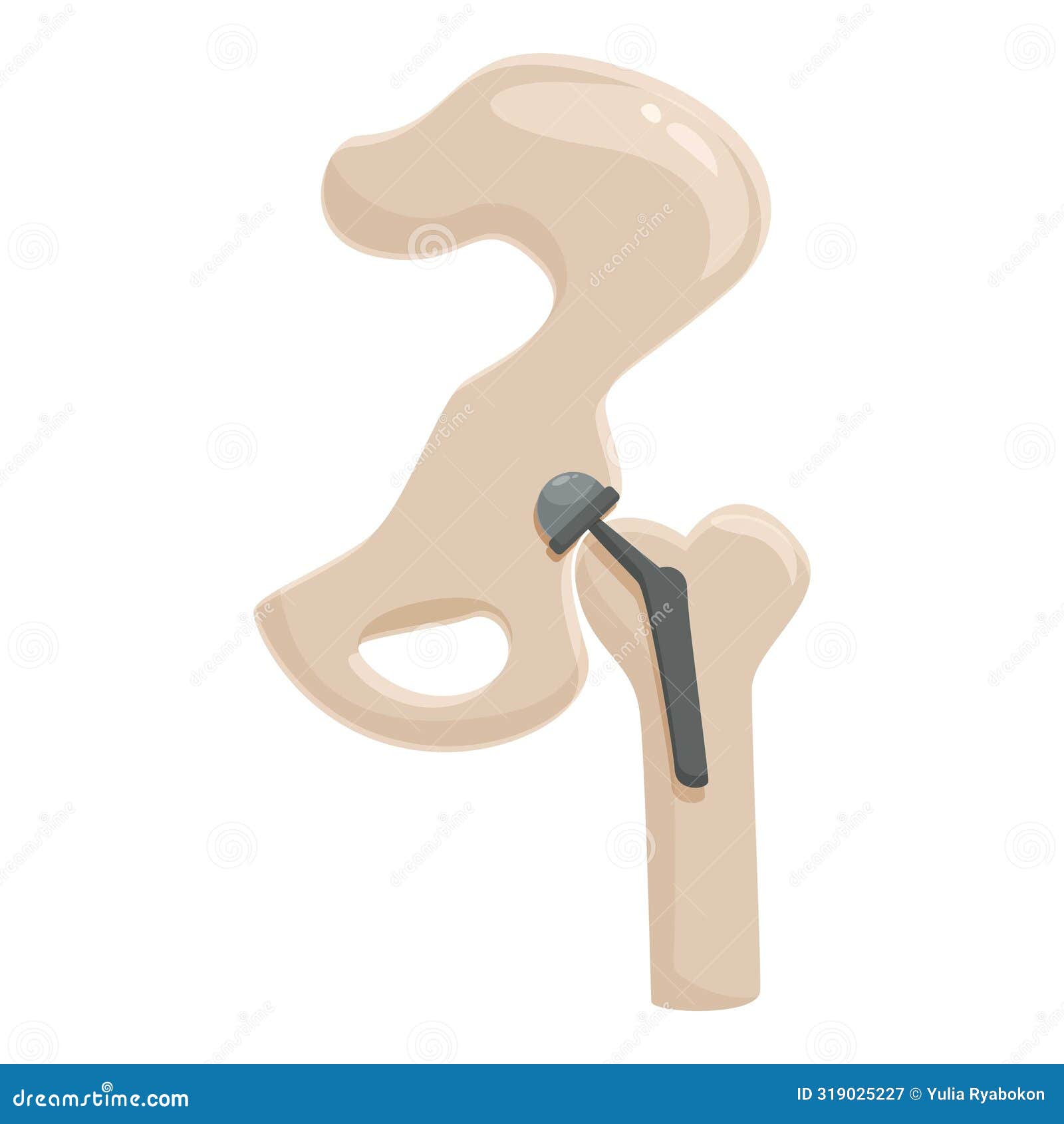 Artificial Hip Joint Replacement Illustration Stock Vector ...