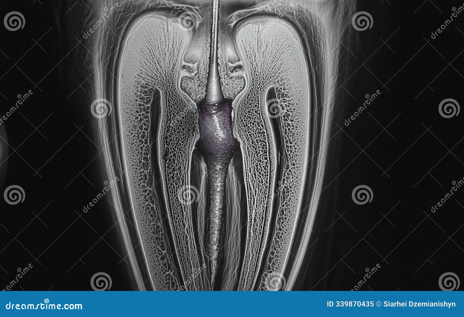 Detailed View of a Tooth with Intricate Root Structure Captured through ...