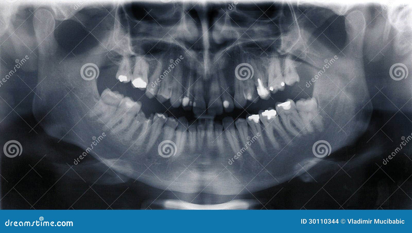 X-ray scan of human teeth stock photo. Image of mouth - 30110344