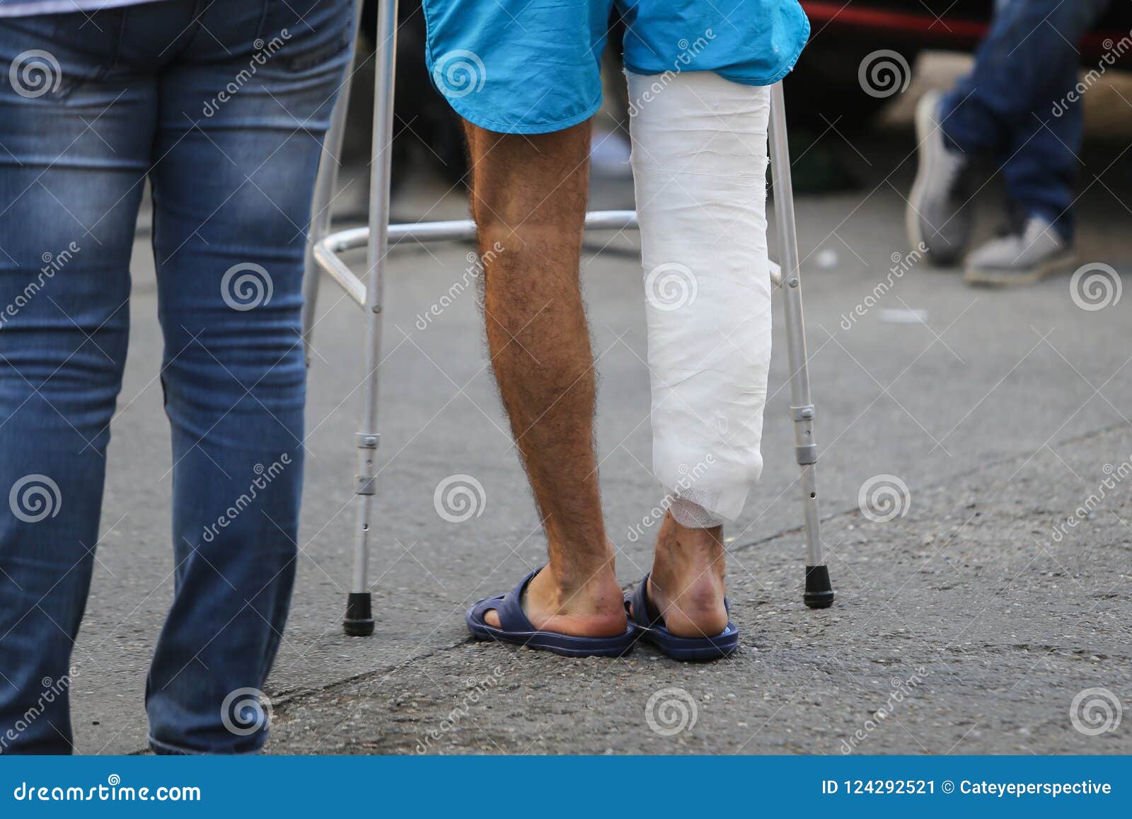 Details Van Het Been in Een Gipsverband Stock Afbeelding - Image of ...