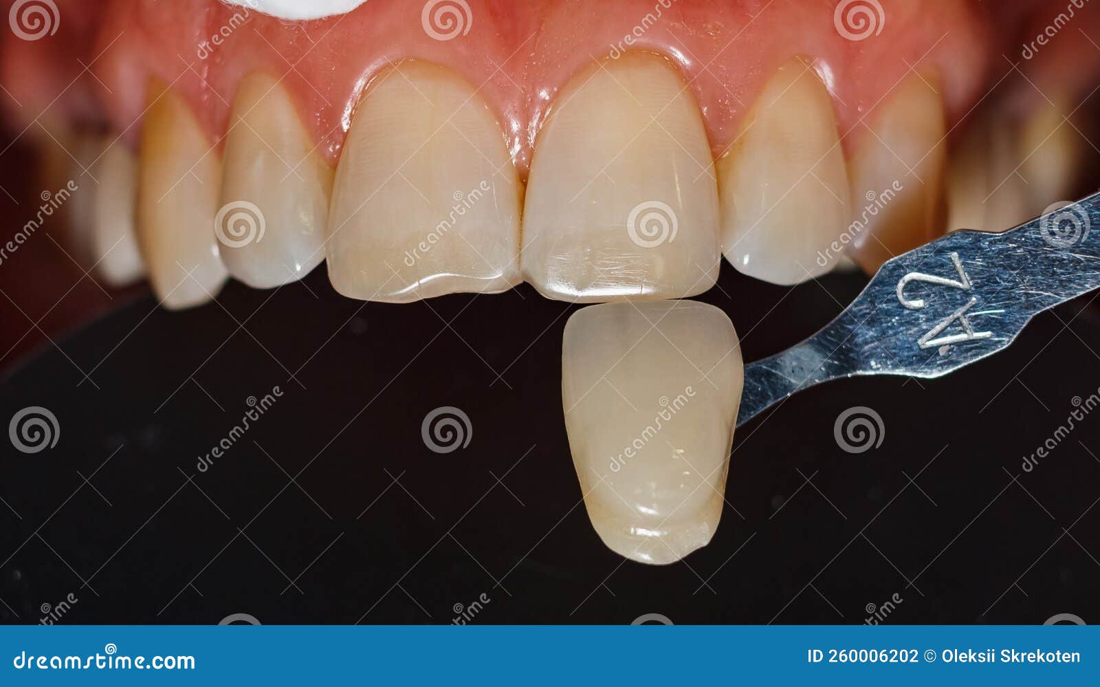 Determination of Tooth Color Using a Sample on a Black Background ...