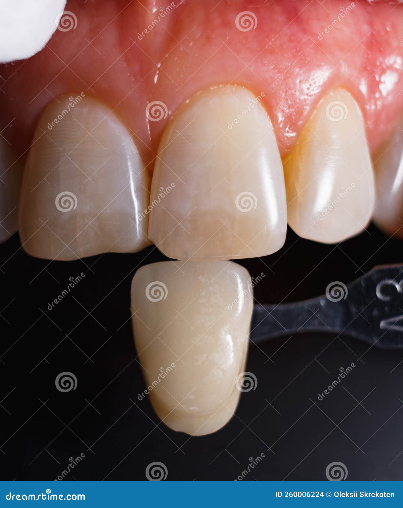 Determination of Tooth Color Using a Sample on a Black Background ...