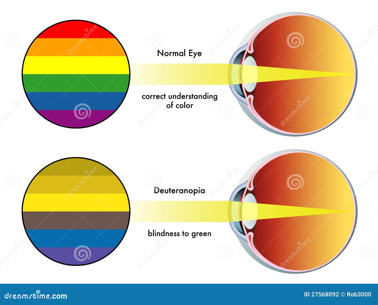 Deuteranopia stock photo. Image of genetic, ophthalmology - 27568092