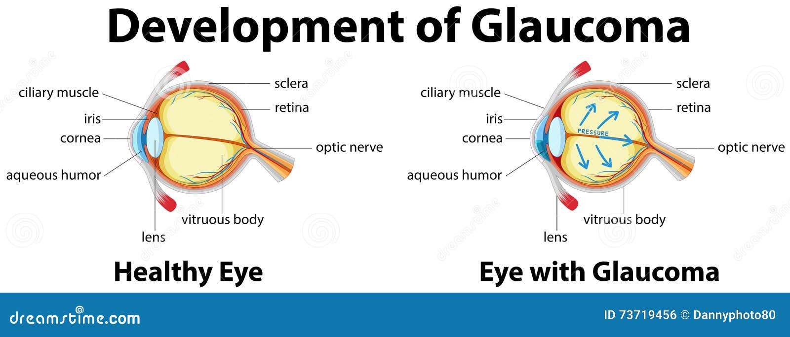 Glaucoma. Human Eye. Vector Sign For Web Graphics. | CartoonDealer.com ...