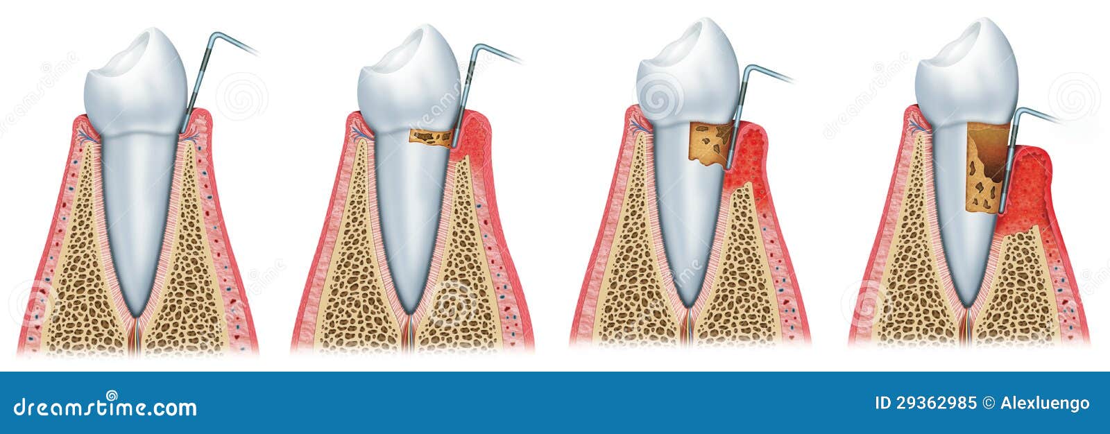 Development of Periodontitis Stock Illustration - Illustration of mouth ...