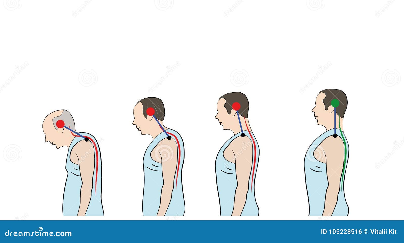 Development of a Stooped Stance with Age, Showing Increasing Curvature ...