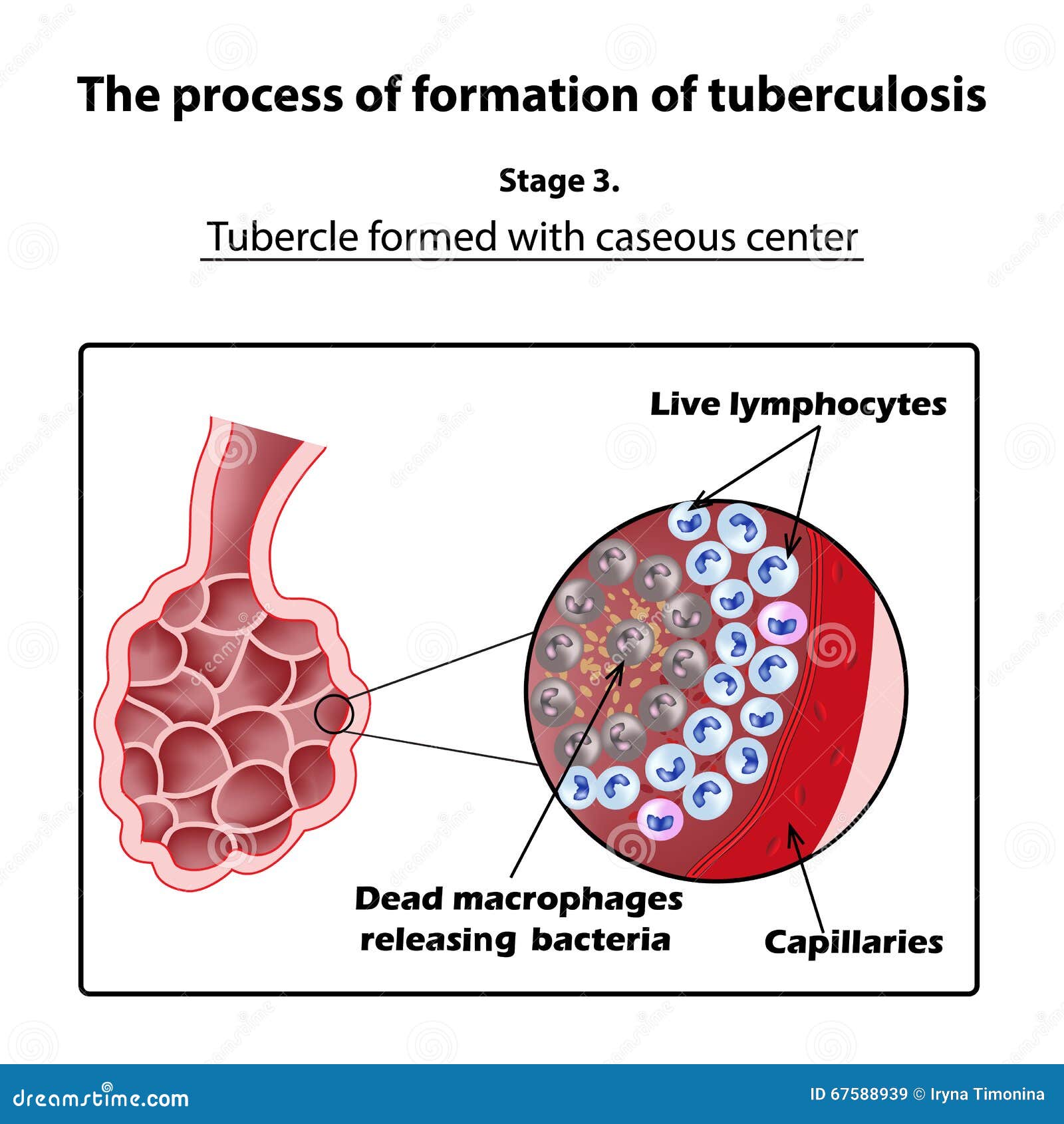 The Development of Tuberculosis. Stage 3. Infographics Stock Vector ...