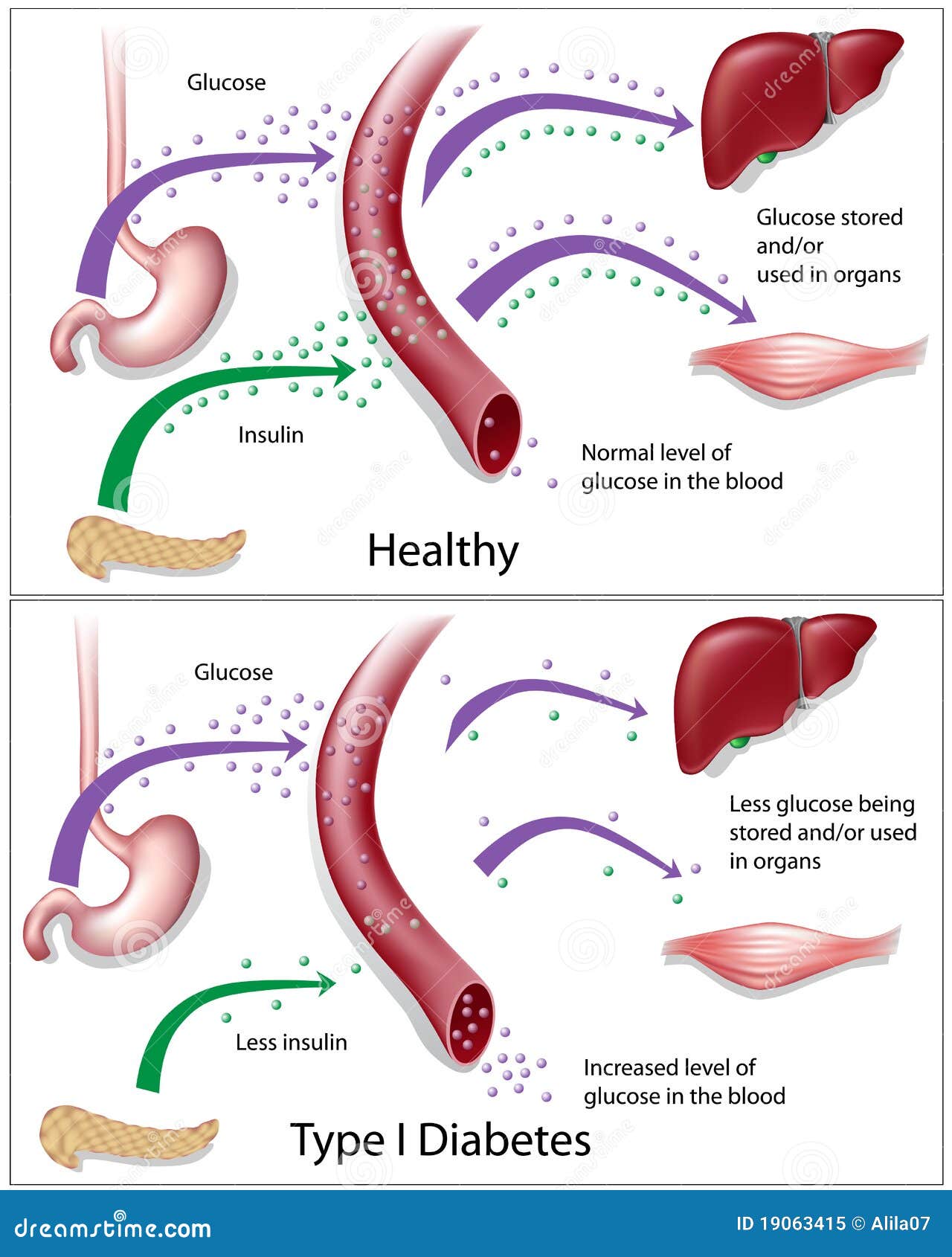 Diabete di tipo 1 illustrazione vettoriale. Illustrazione di sano ...