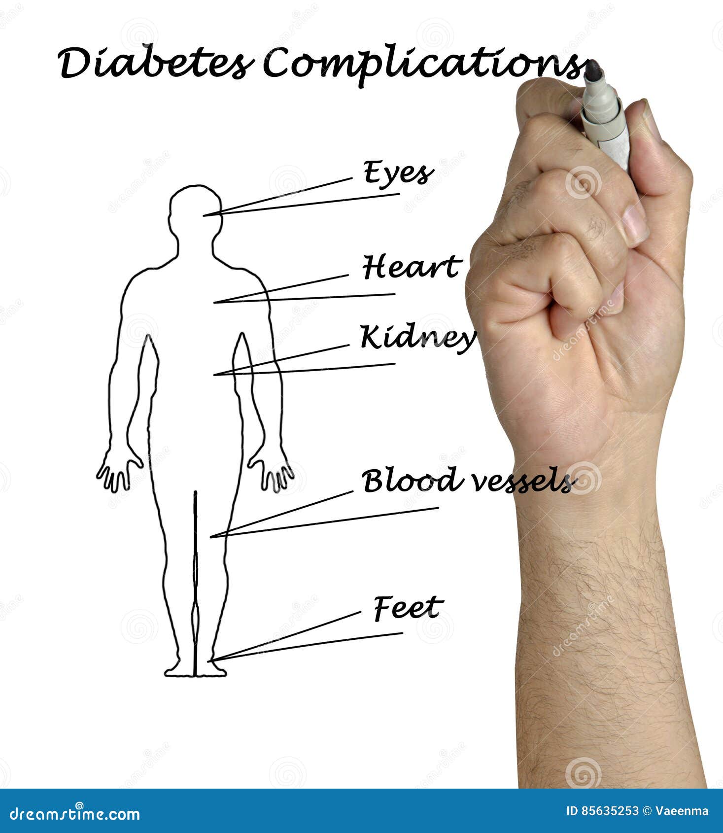 Diabetes complications stock image. Image of diabetes - 85635253