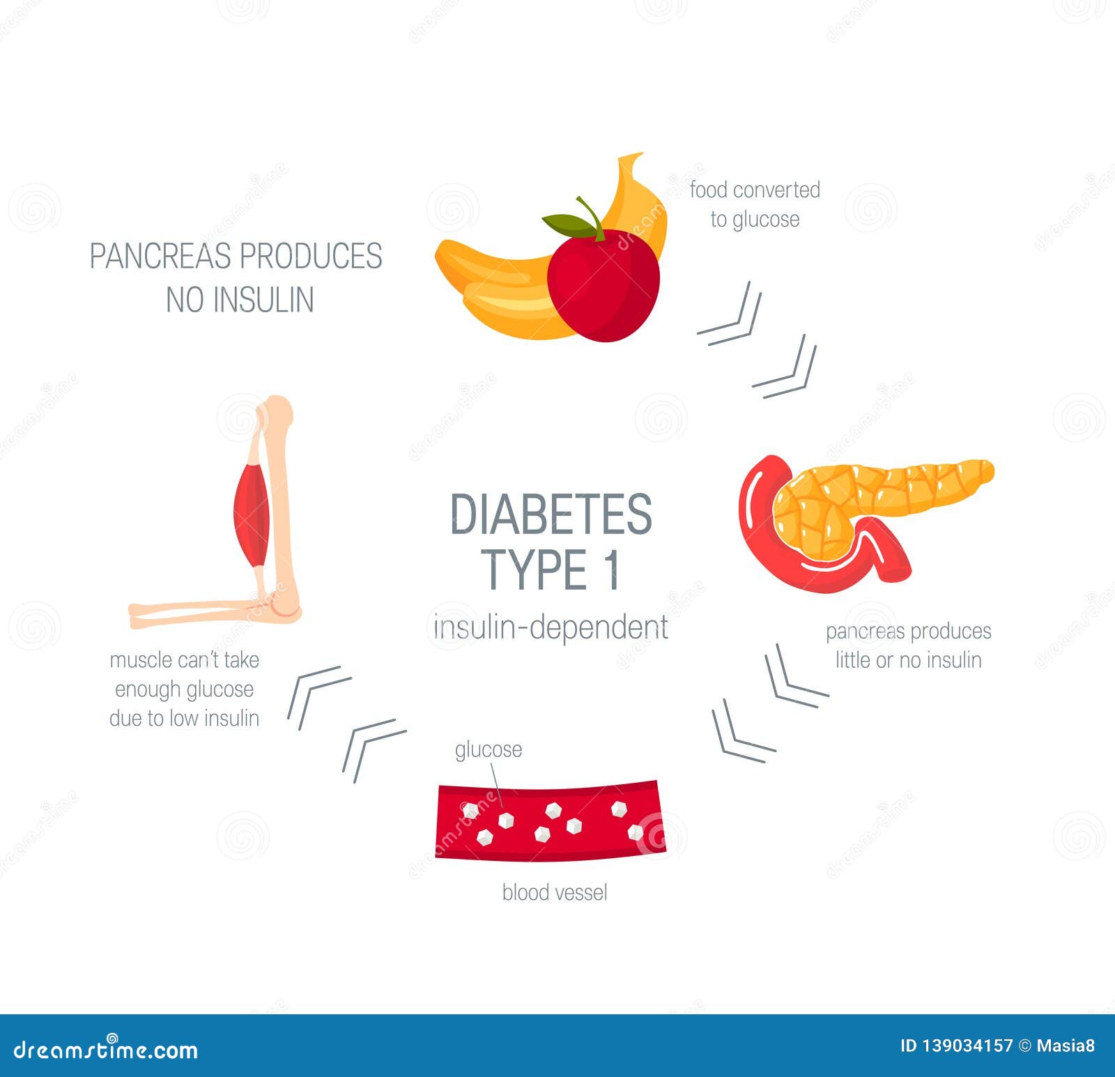 Diabetes Type 1 Concept In Flat Style Vector Stock Illustration