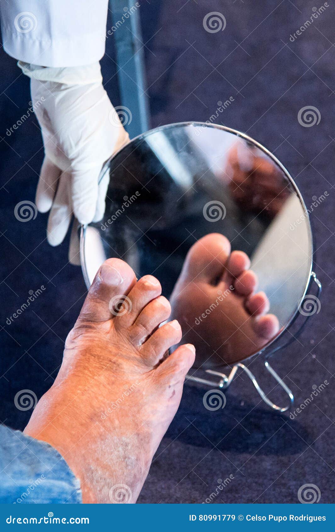 Diabetesvoet redactionele stock afbeelding. Image of besmetting - 80991779