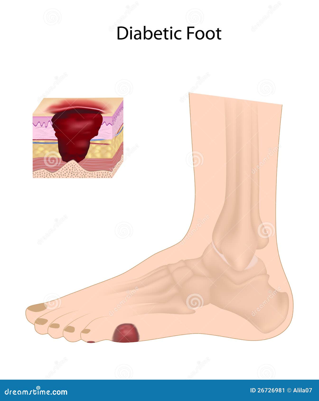 Diabetic Foot stock vector. Illustration of lesion, disease - 26726981