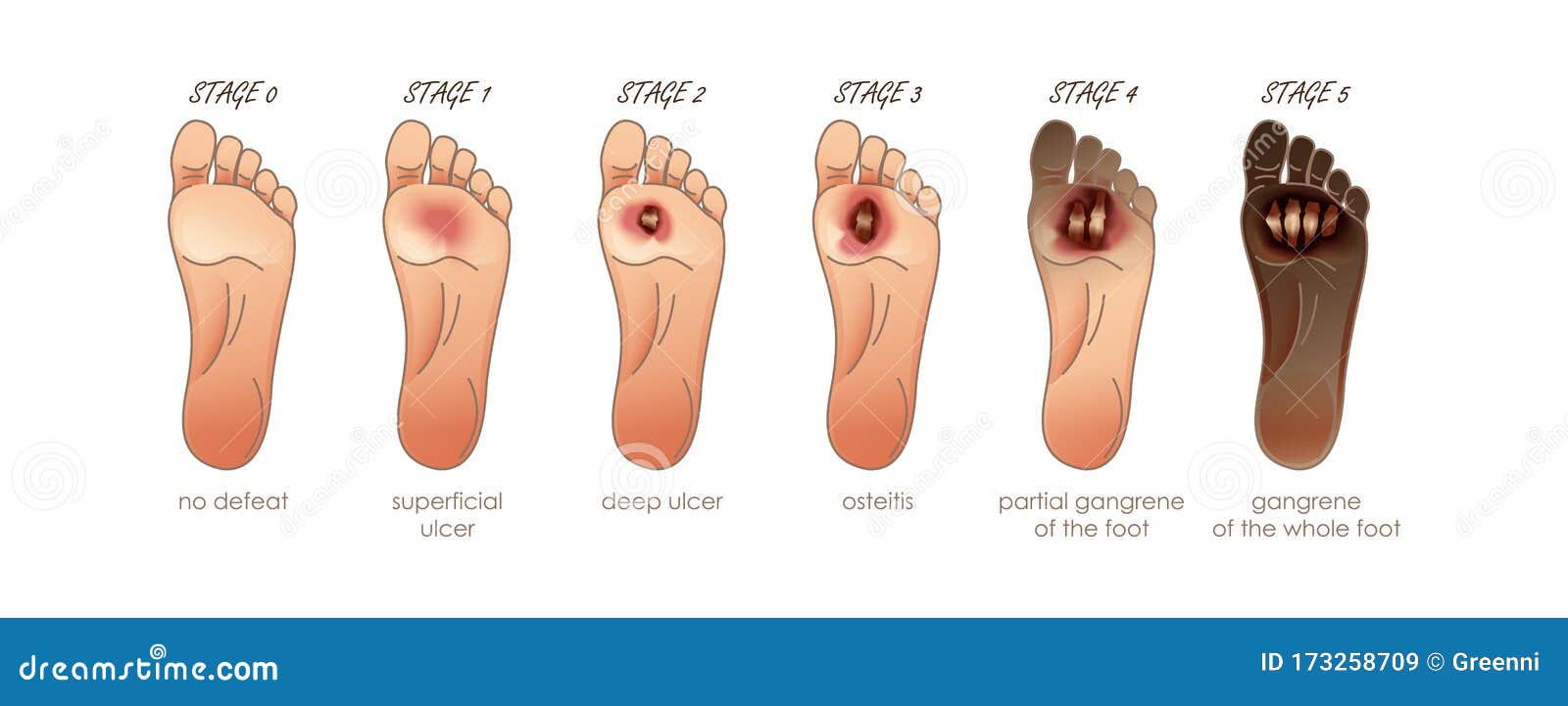 Diabetic Foot Stages Of Defeat Stock Illustration Illustration Of Heel Diabetes 173258709